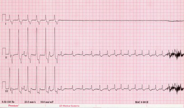 Echocardiogram vs. EKG/ECG: what to expect - CardiacDirect