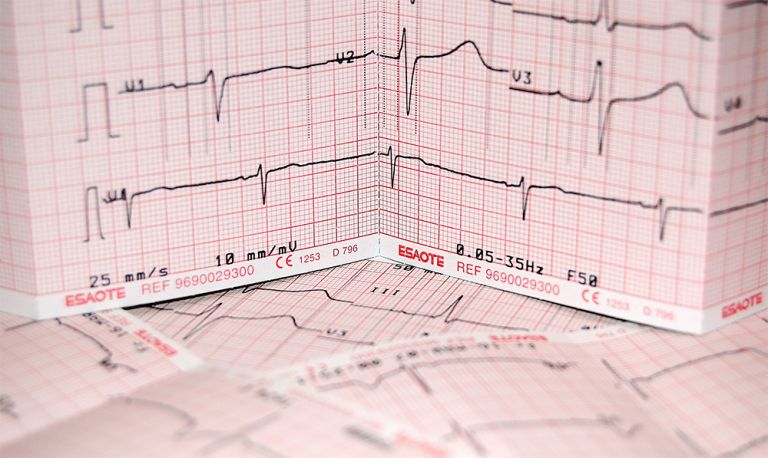 How to Read an EKG Strip in 5 Steps - CardiacDirect