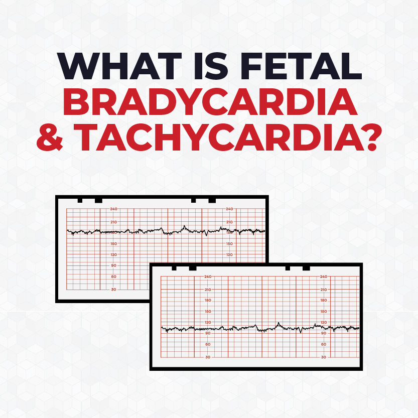 What is Fetal Bradycardia and Tachycardia? - CardiacDirect